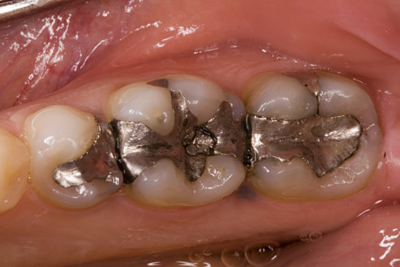 Amalgam Filling - Dr. Surya & Associates